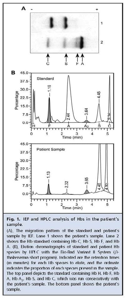 A Patient with a Previous Diagnosis of Hemoglobin S C Disease | myadlm.org