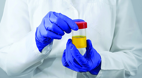 Urine Reflex Testing: Why and How? | myadlm.org